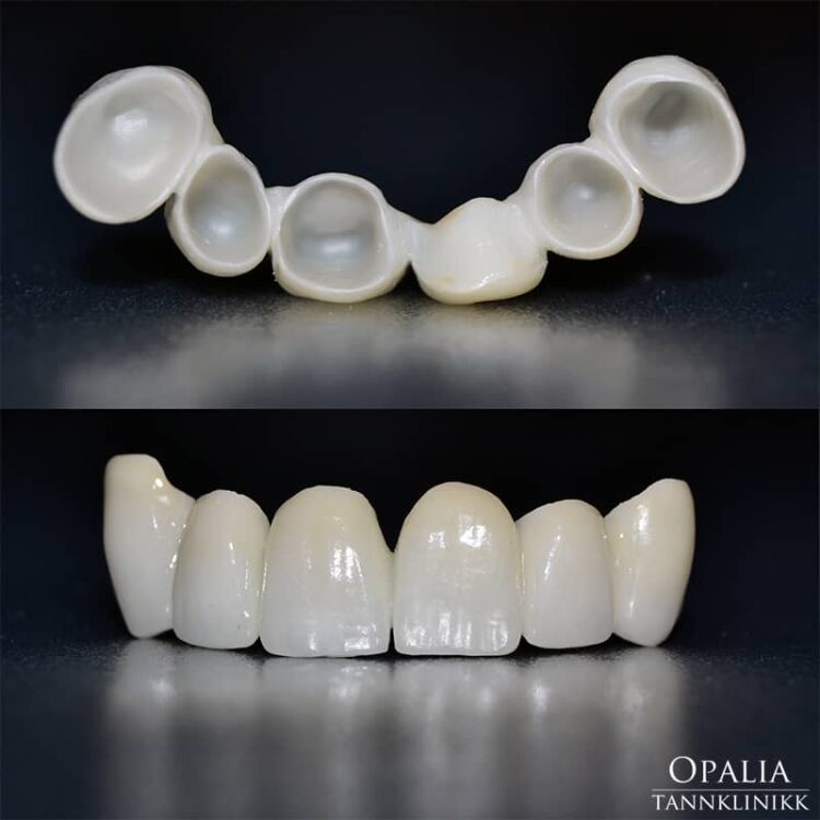 Tannbro / porselensbro - Opalia tannklinikk