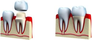 Porselenskrone - tannkrone - Opalia tannklinikk